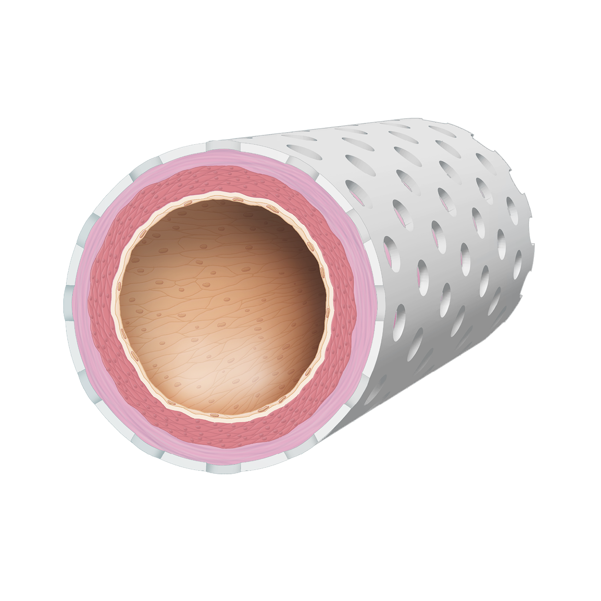 How SelfWrap Works - VenoStent
