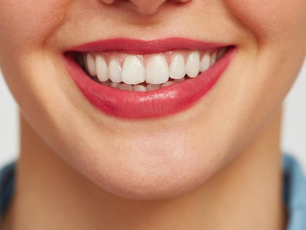Smile Makeover