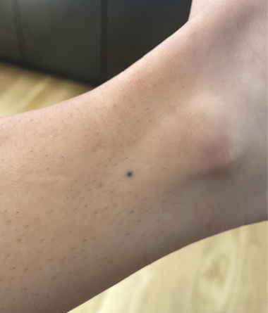 Ephemeral Ink for Radiation Therapy - Ephemeral Tattoo