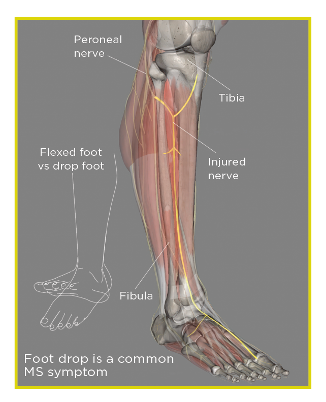 Orthotics for MS Walking Difficulties | National MS Society