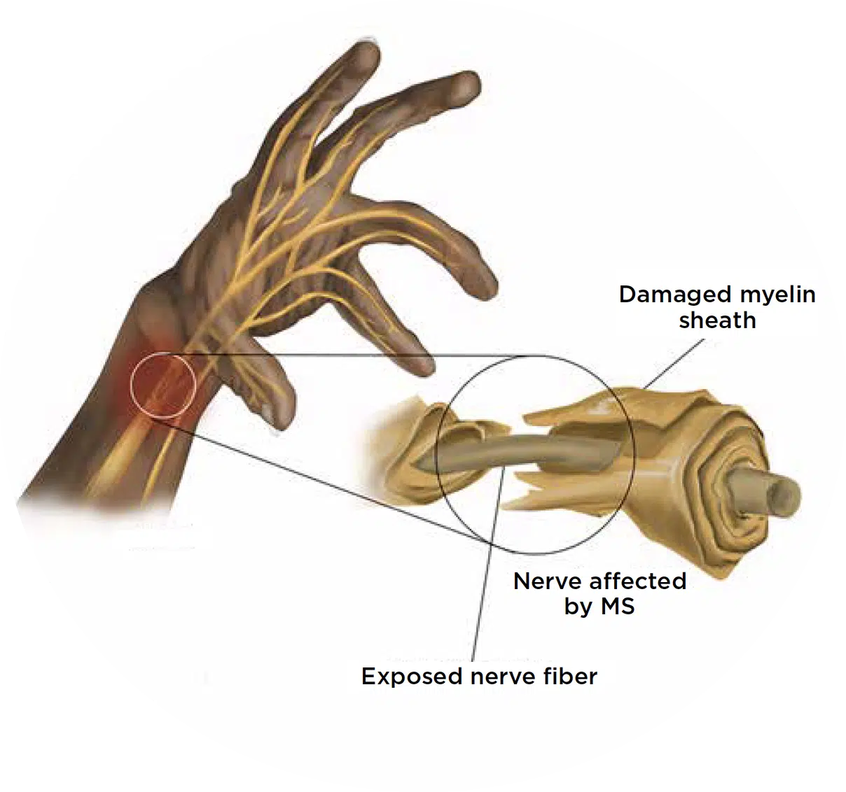 Mind Over Muscle: Spasticity in MS | National MS Society