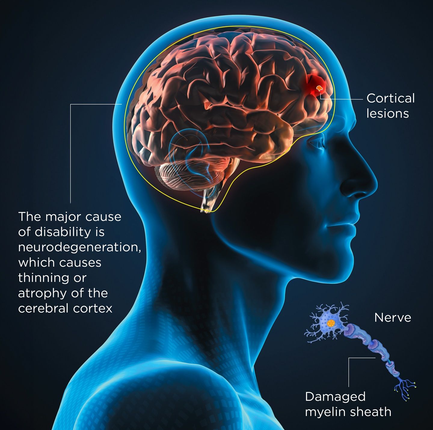 What is PIRA in Multiple Sclerosis? | National MS Society