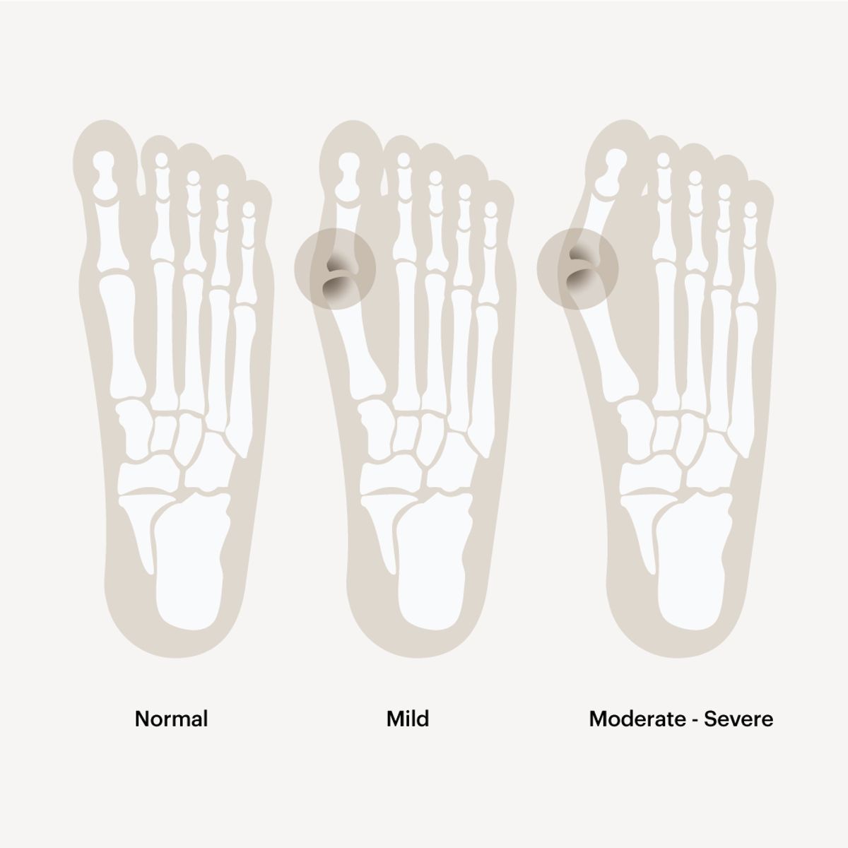 A Podiatrist's Guide to Bunions & Shoes | Bared Footwear