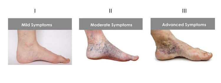 3 Stages of Venous Insufficiency